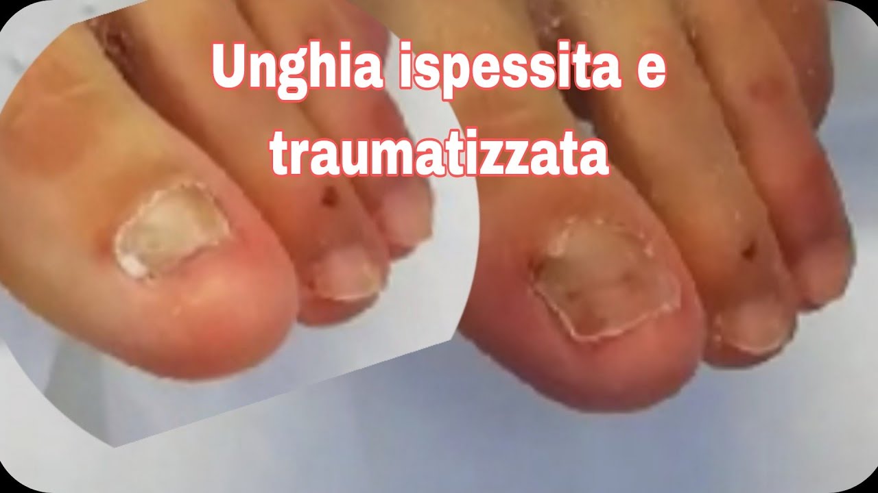 Alluce con unghia ispessita e traumatizzata! Guarda come l'ho ...