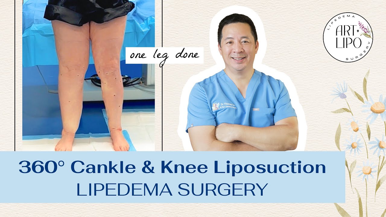 360° Cankle & Knee Liposuction | Lipedema Surgery | Expert Dr. Thomas ...