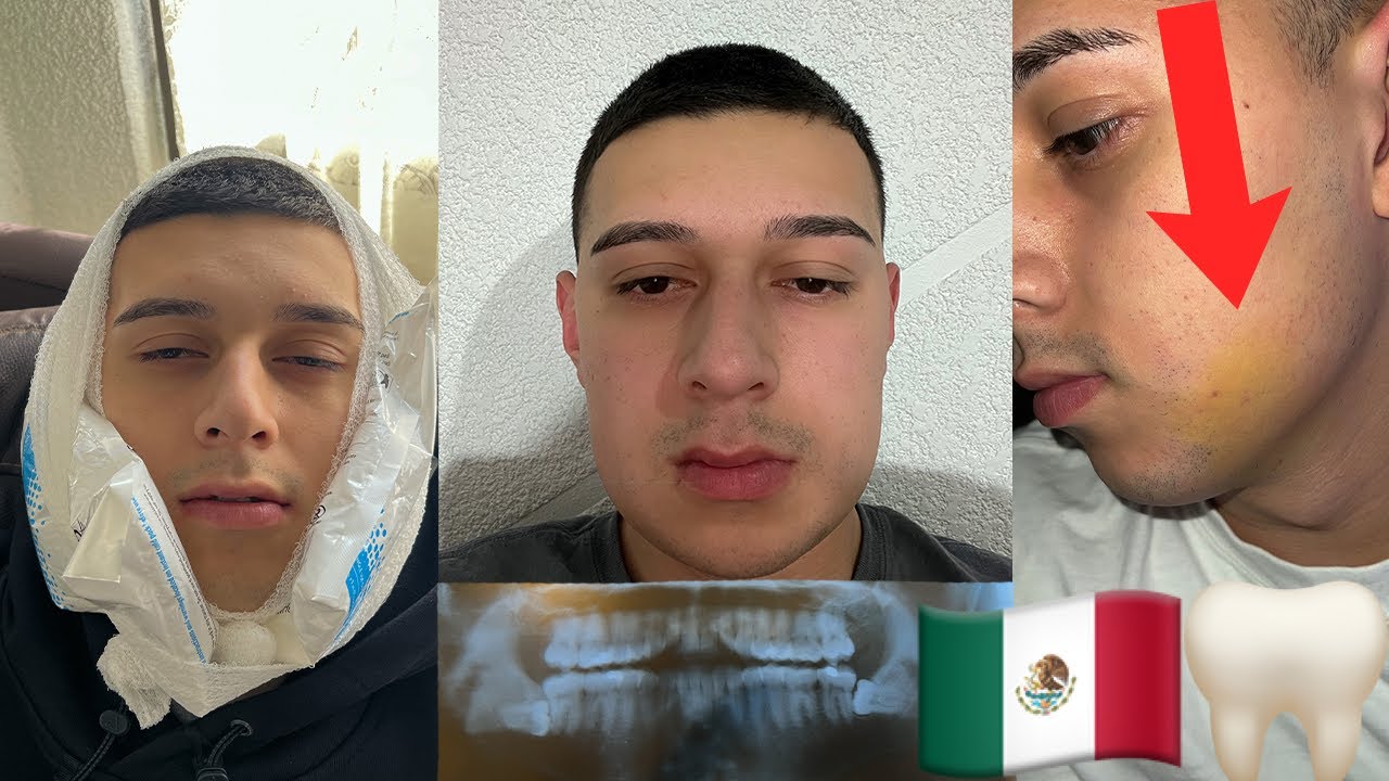 I Flew To Mexico To Remove My Wisdom Teeth🇲🇽....... - YouTube