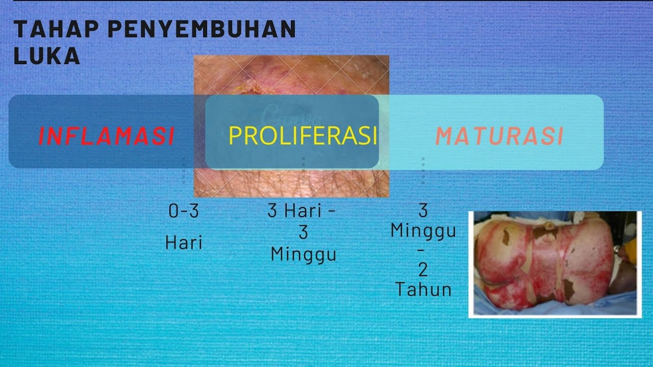 Mengobati Luka Bakar : Tahap Penyembuhan Luka Bakar - YouTube