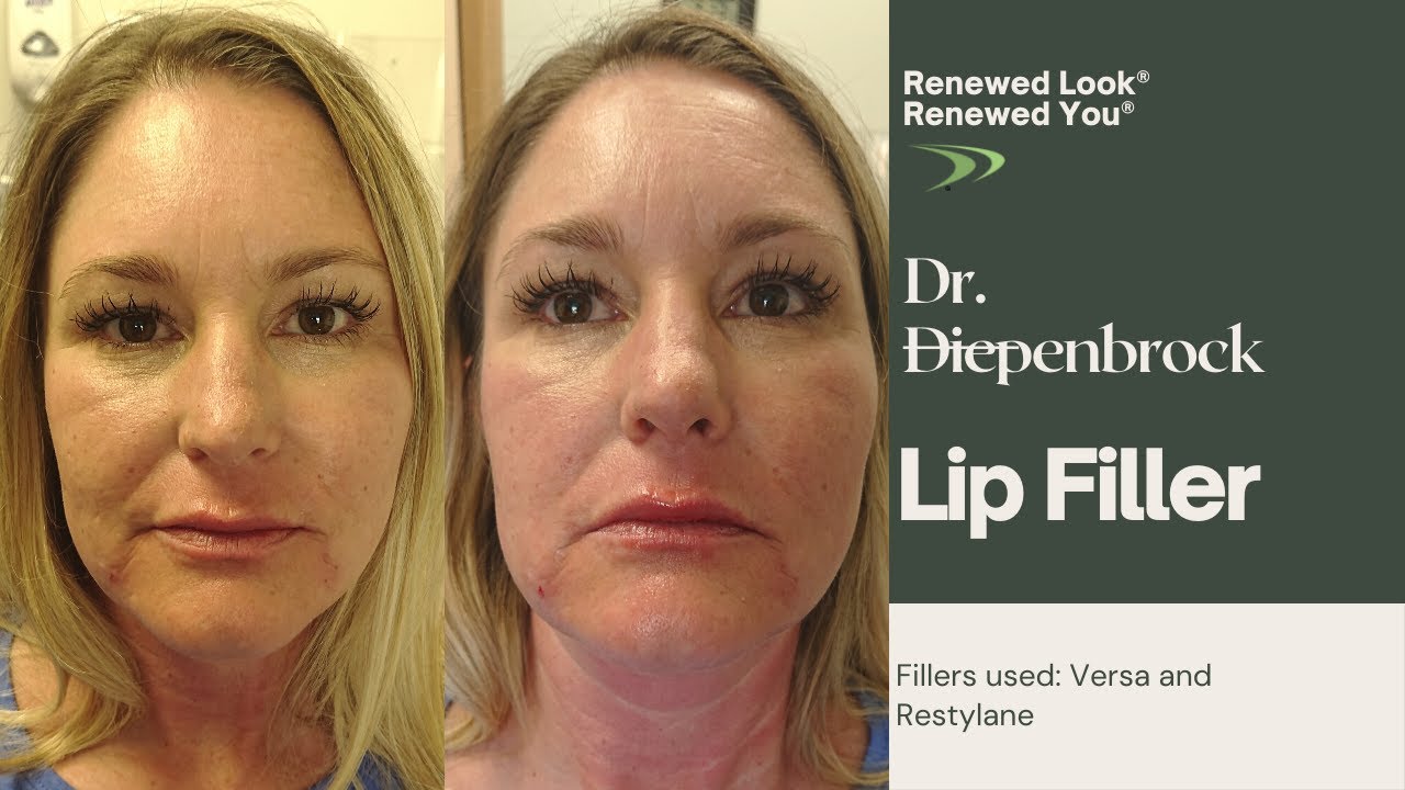 Lip filler before and after - w/ Versa and Restylane Refyne Fort Wayne ...