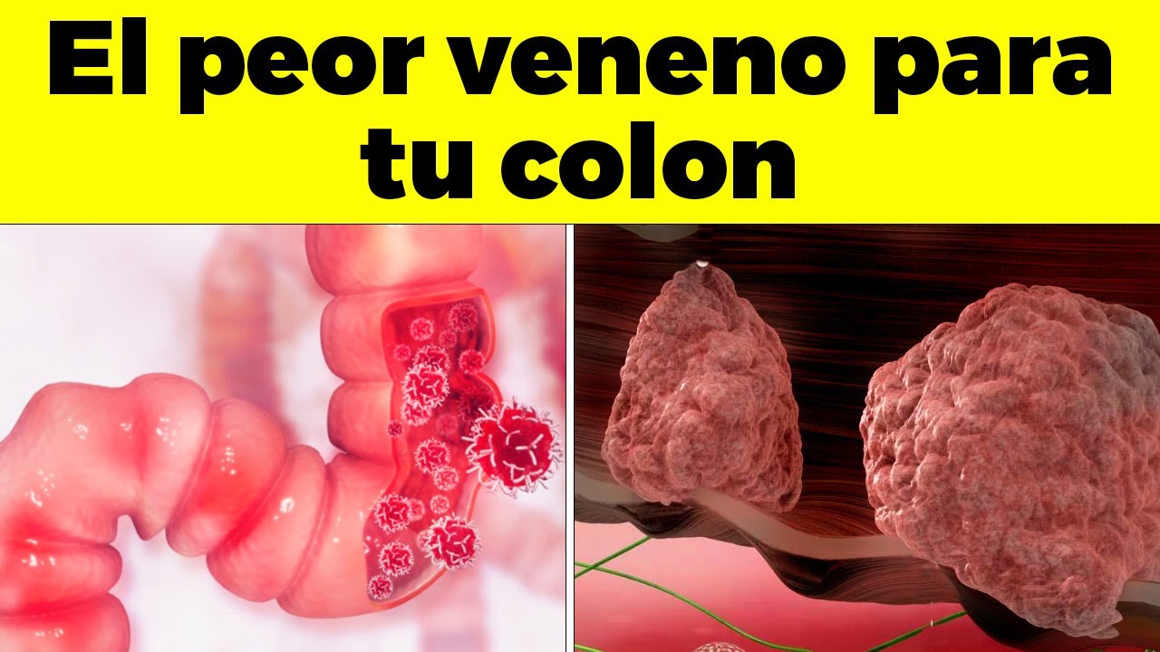 El PEOR ALIMENTO que Causa CÁNCER de COLON! causa daño al menos que ...