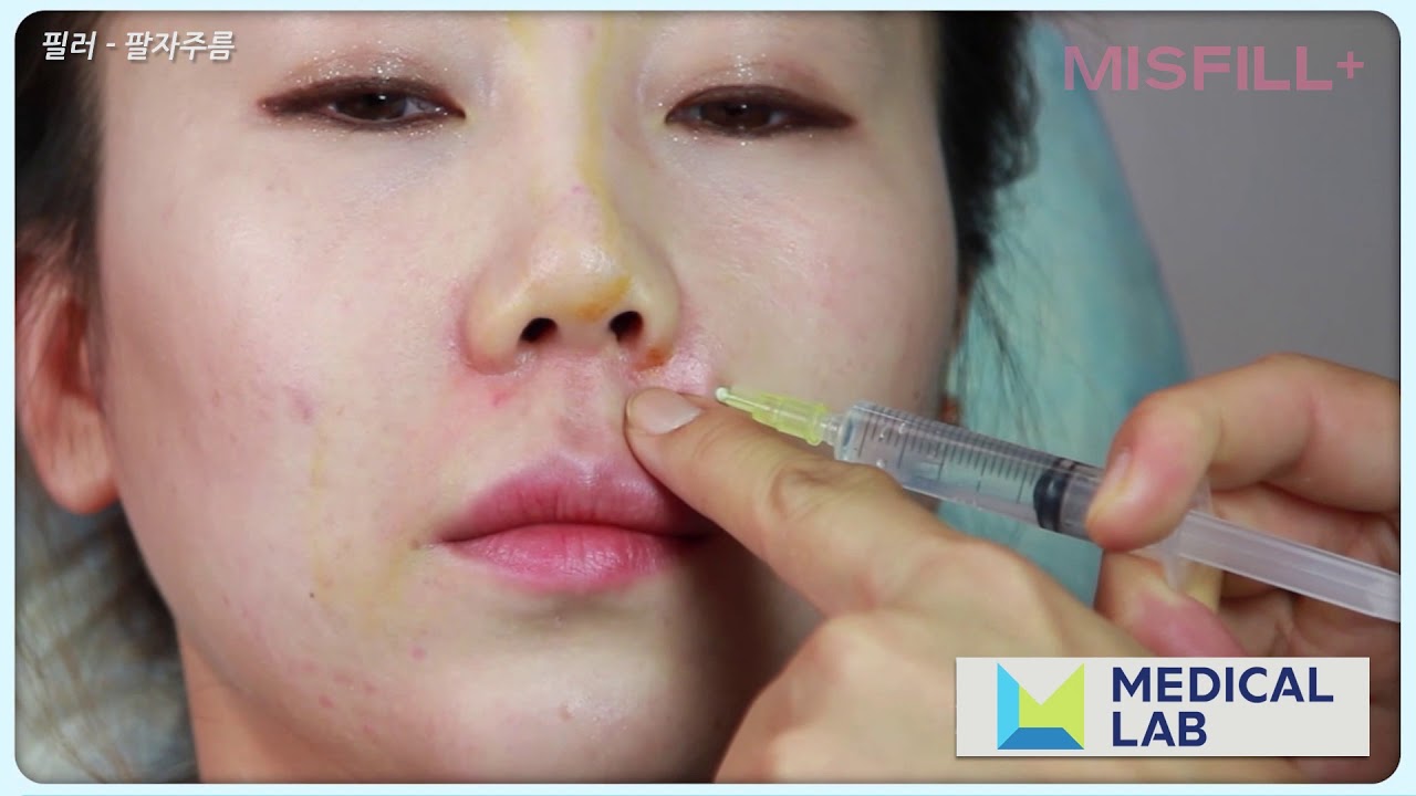 MISFILL+ filler. smile lines - YouTube