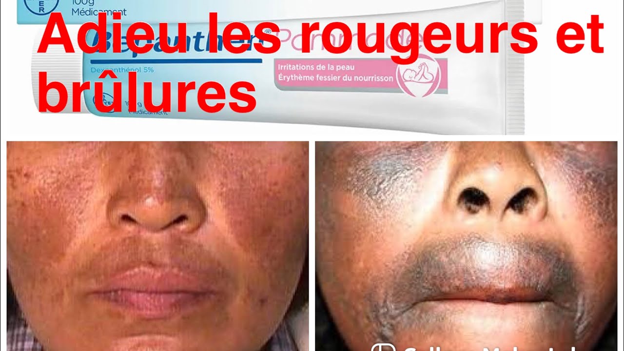 BEPENTHENE POMMADE:POUR TRAITER LES ROUGEURS,LES BRÛLURES,IRRITATIONS🔥 ...