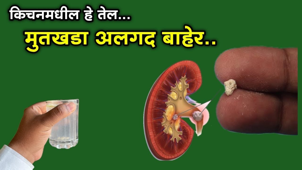 ऑपरेशन पूर्वी घरातील हे एक तेल प्या, मुतखडा अलगद बाहेर फेका। mutkhada ...