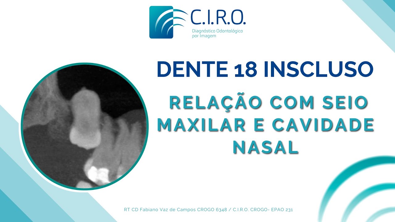 Dente 18 incluso: relação com estruturas adjacentes - YouTube