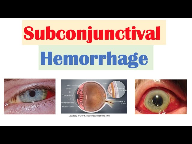 Mild Subconjunctival Hemorrhage