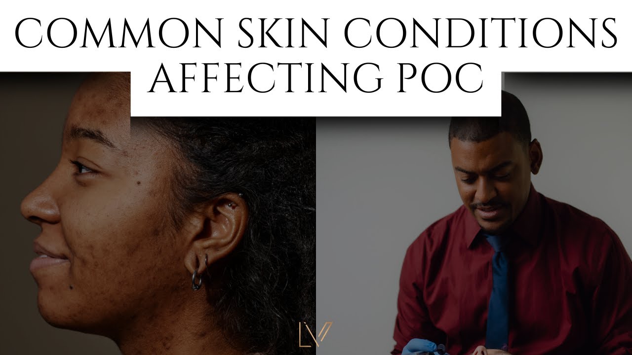 Common Skin Conditions Affecting African Americans #dermatology - YouTube