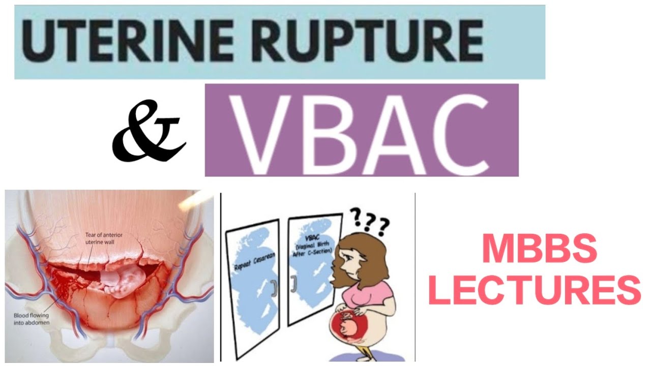 Uterine Rupture + Vaginal birth after C section ( VBAC) - YouTube