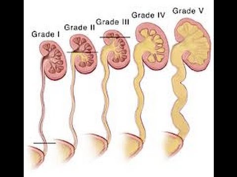 vesico-uretral reflux - YouTube