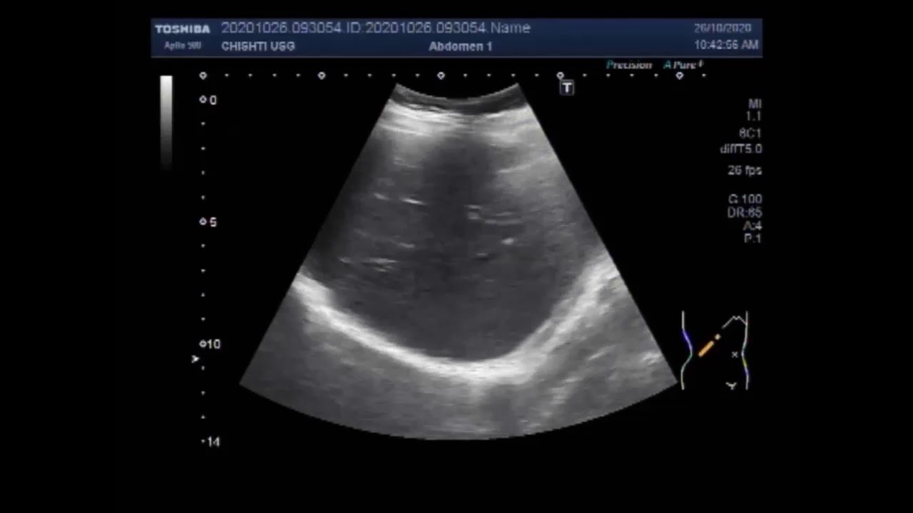 Ultrasound Video showing Two types of Hepatic Masses. - YouTube