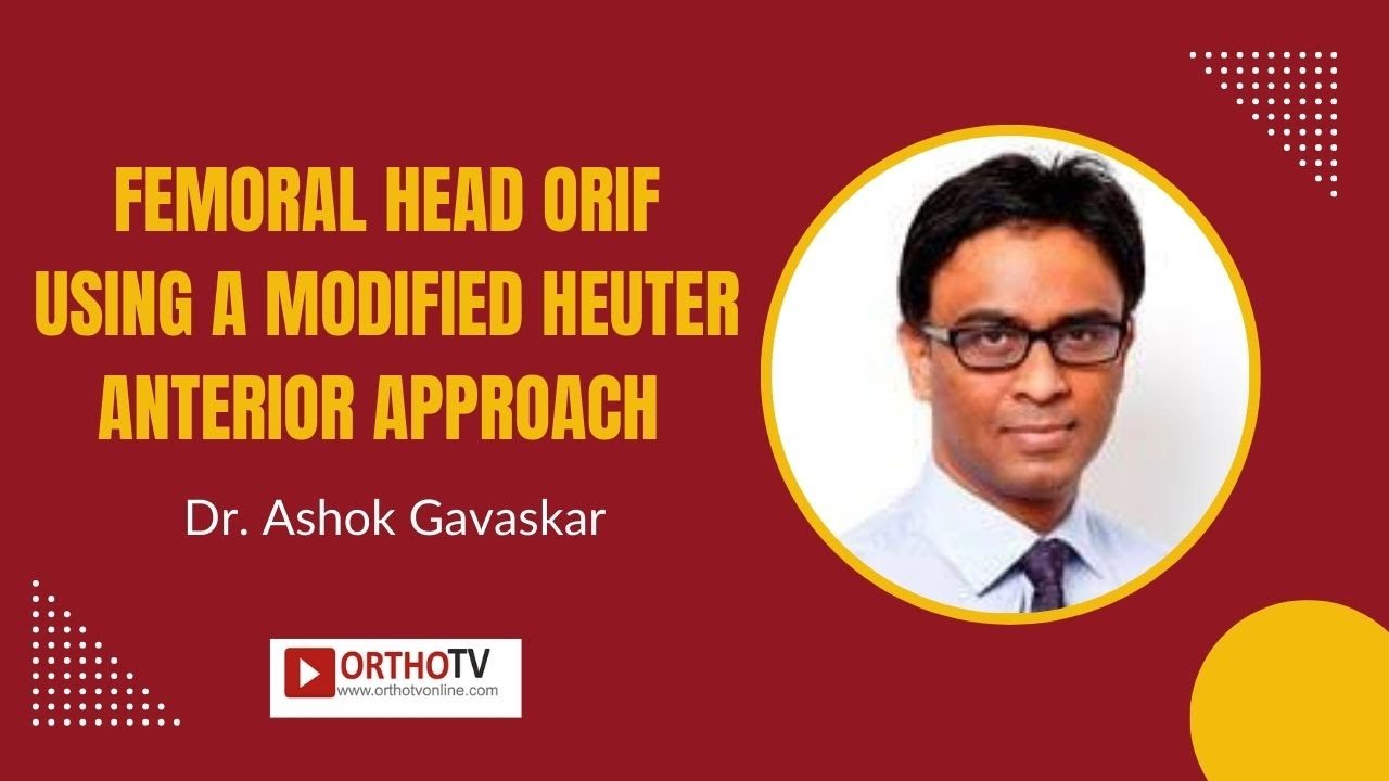 Femoral head ORIF using a modified Heuter anterior approach - Dr. Ashok ...