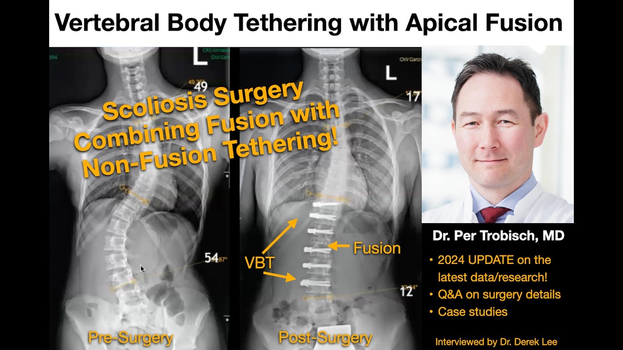 Dr. Per Trobisch, MD on Vertebral Body Tethering (VBT) with Apical ...