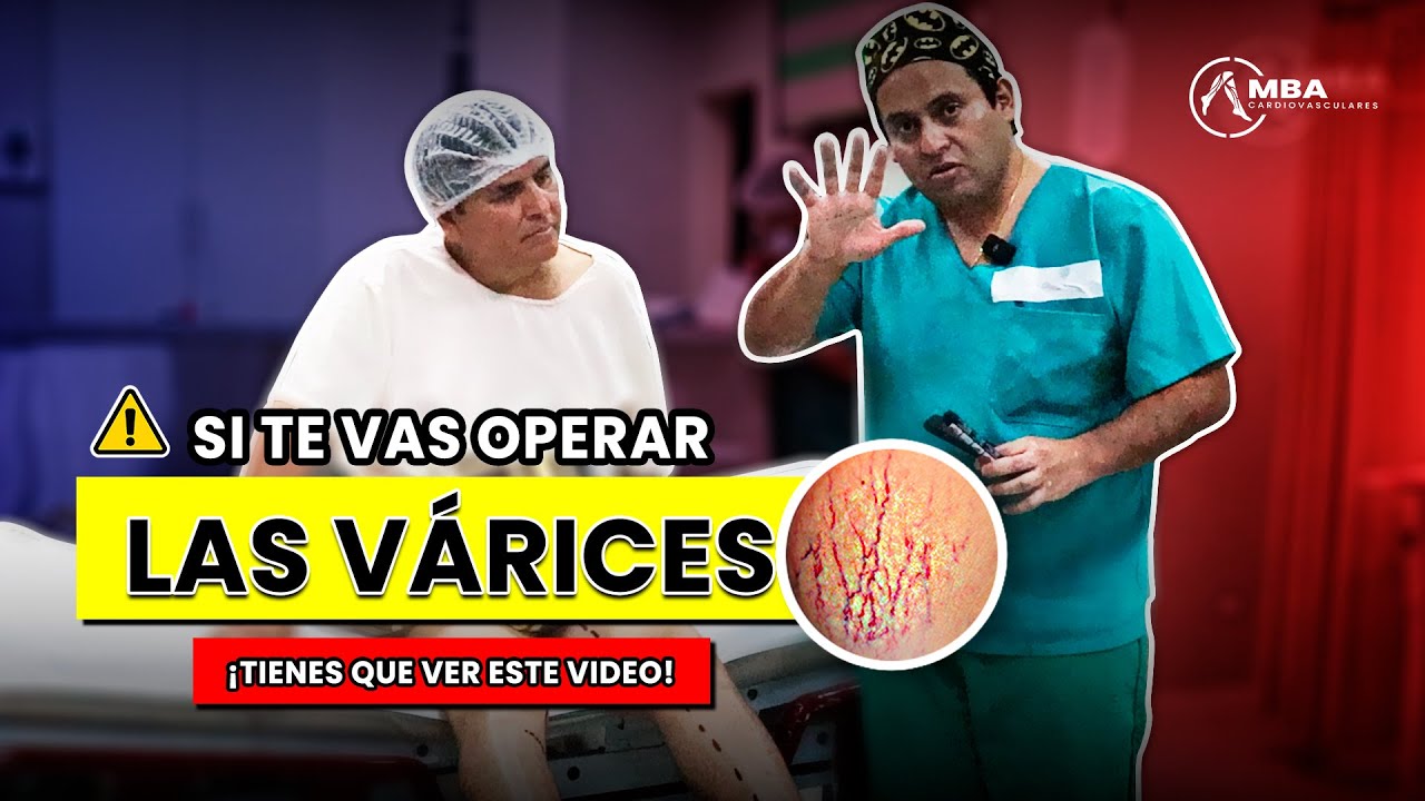 PASO a PASO en la cirugía de VÁRICES con LÁSER (Antes, durante y ...