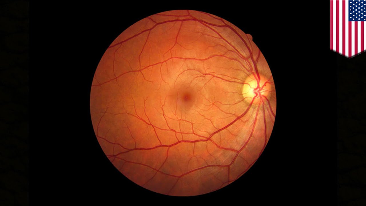 Solar retinopathy: Why you shouldn't stare at the sun, even during a ...