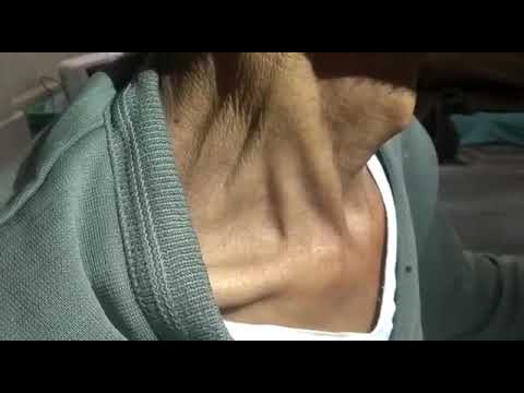 Corrigan's Pulse (Dancing Carotid) of Aortic Regurgitation, Dept. of ...