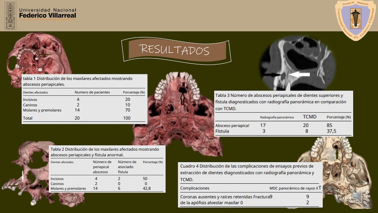 Absceso periapical de los maxilares y sus fistulizaciones: Estudio de ...