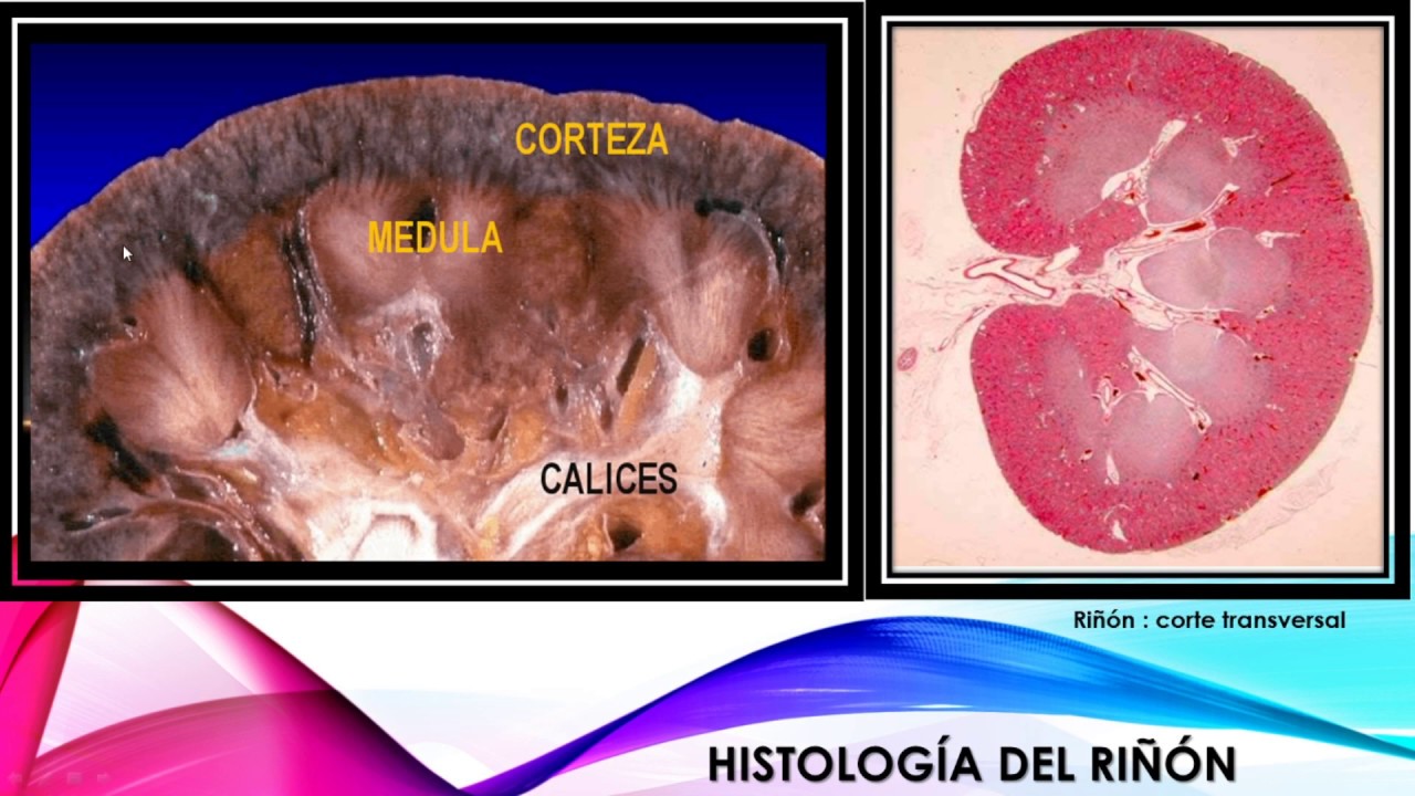 Hidronefrosis - YouTube