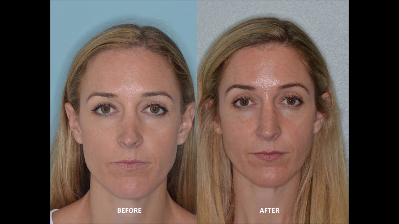 Perfecting Revision Rhinoplasty for the Over-Projected Nasal Tip ...