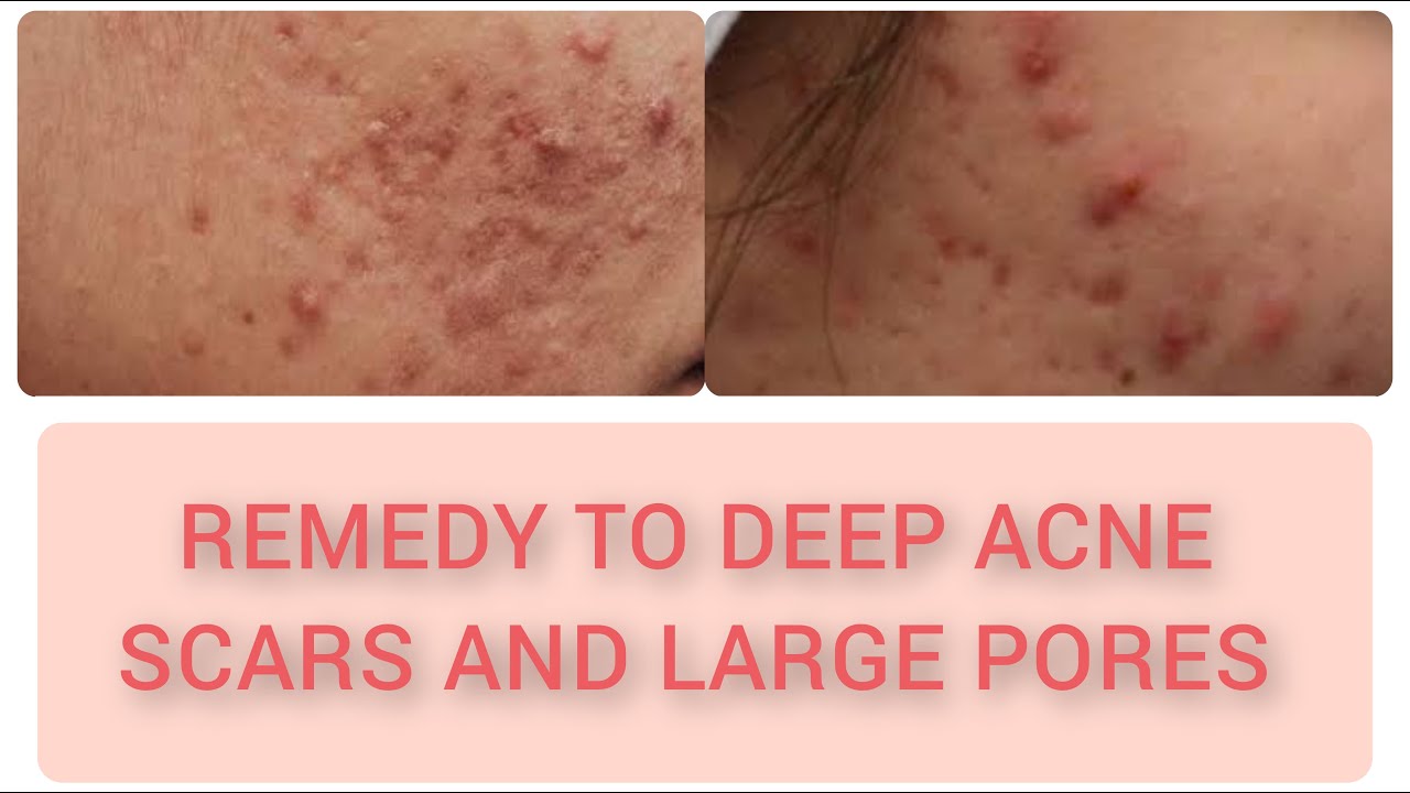 Remedy to remove deep acne scars and open large pores | Swalpa ...