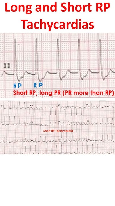 Long and Short RP Tachycardias - YouTube Long and Short RP Tachycardias - YouTube