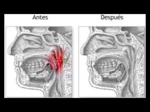 HIPERTROFIA ADENOIDES - YouTube