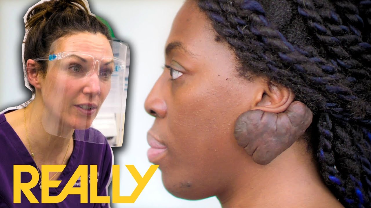 Woman Travels 6,000 Miles To Have Her Kidney-Shaped Keloid Removed ...