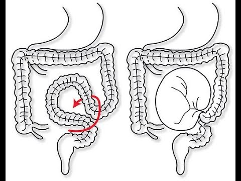 Sigmoid Volvulus Decompression