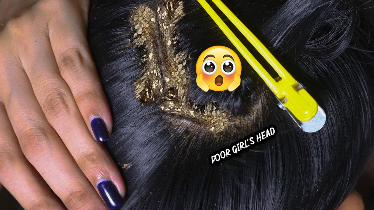Dandruff And Picking A lots Worm On Biggest #155 - YouTube