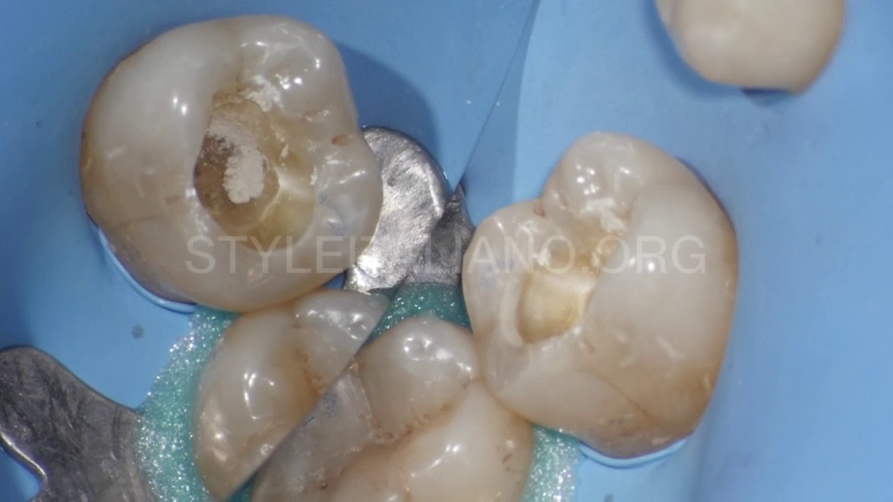 MTA pulp capping - YouTube