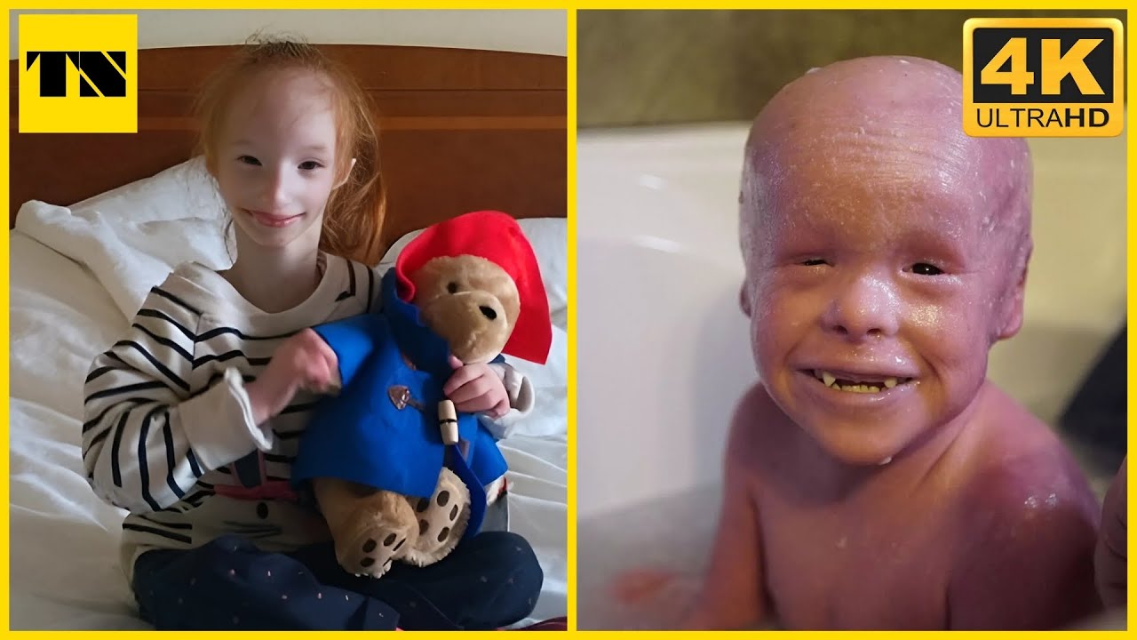Extraordinary Children with Rare Conditions | Then and Now 2025 - YouTube