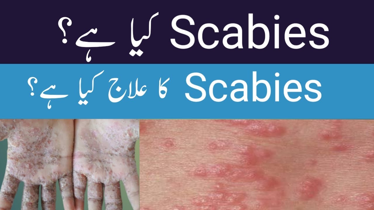 Scabies Causes, Symptoms, Prevention And Treatment in Urdu/Hindi - YouTube