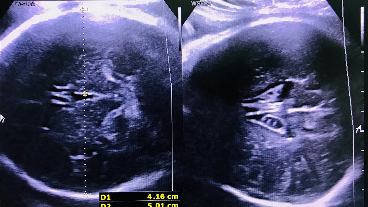 Fetus 40 weeks: Hemimegaencephaly, subependymal cyst - YouTube