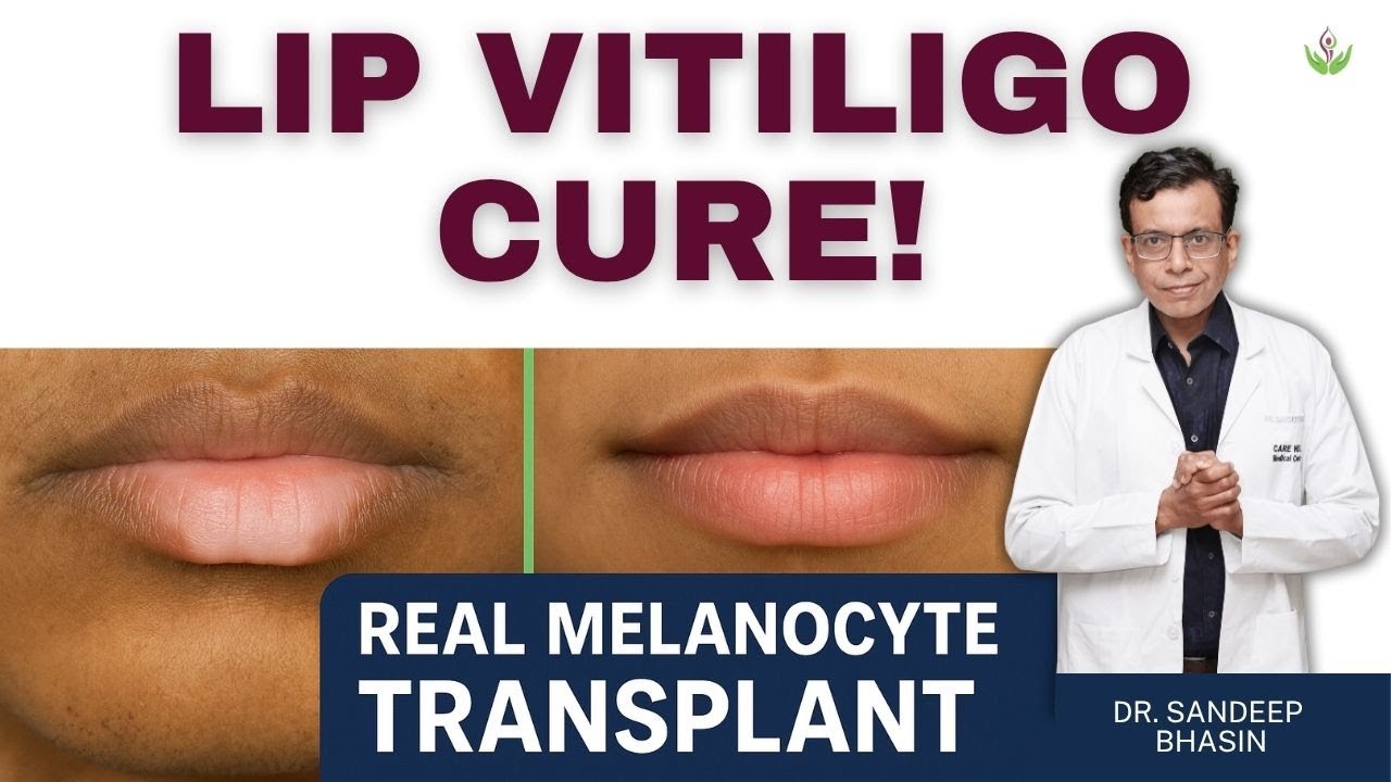 Melanocyte Transplant for Lip Vitiligo | Essential Procedure Guide for ...
