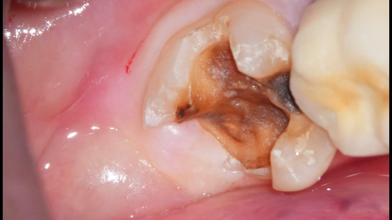 Taking an impression from crown lengthening for a second molar with a ...