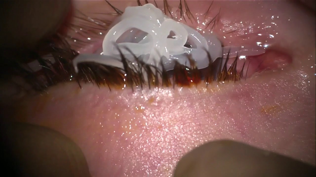 Vernal plaque surgery - YouTube