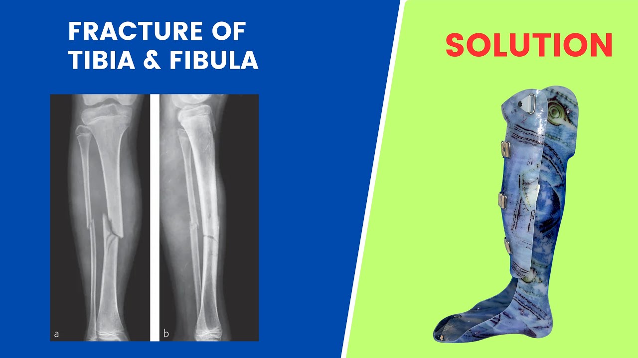 Fracture Management of Tibia and Fibula by the Patella Tendon Brace ...