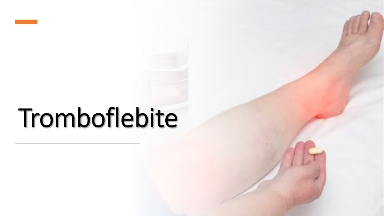 Tromboflebite - YouTube