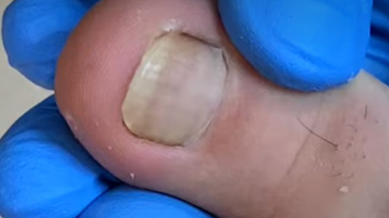 Pedicure tutorial ：Toes become relaxed after trimming【Xue Yidao】 - YouTube