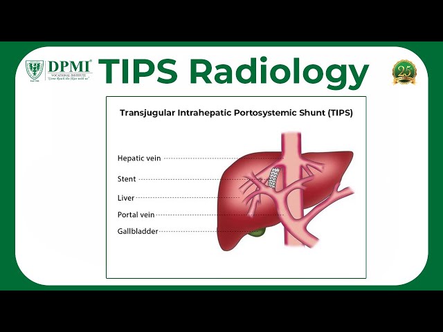 Transjugular Intrahepatic Portosystemic Shunt (tips)