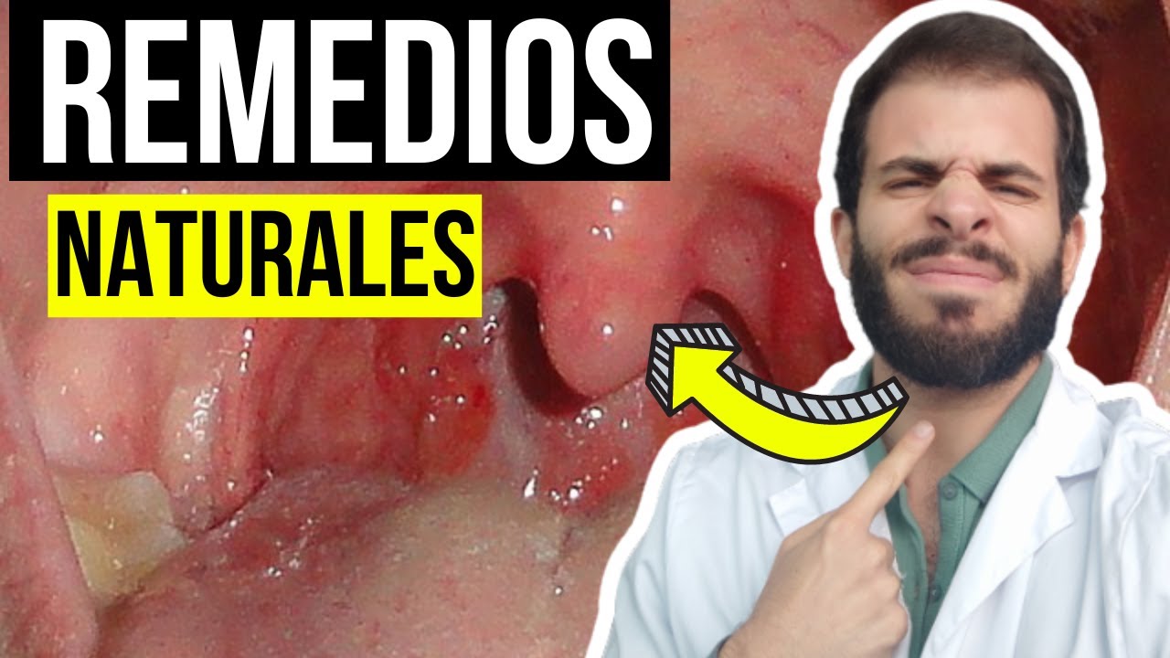 ¿Se puede CURAR la FARINGITIS CRÓNICA? - YouTube