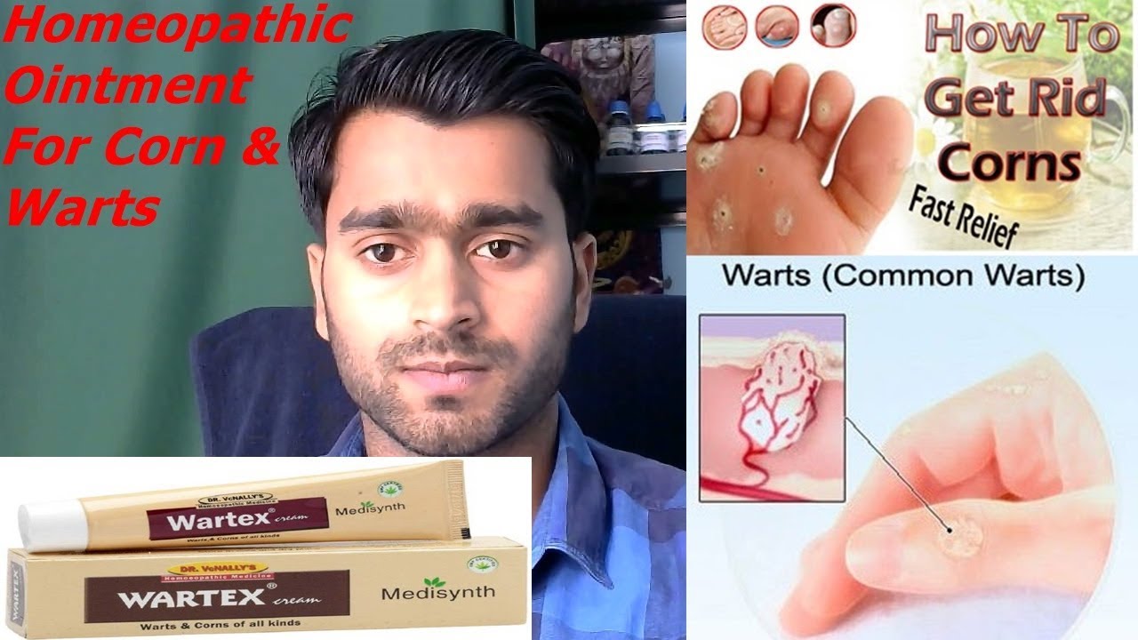 wartex cream#homeopathic cream for warts and corns!! मस्सों और गोखरू के ...