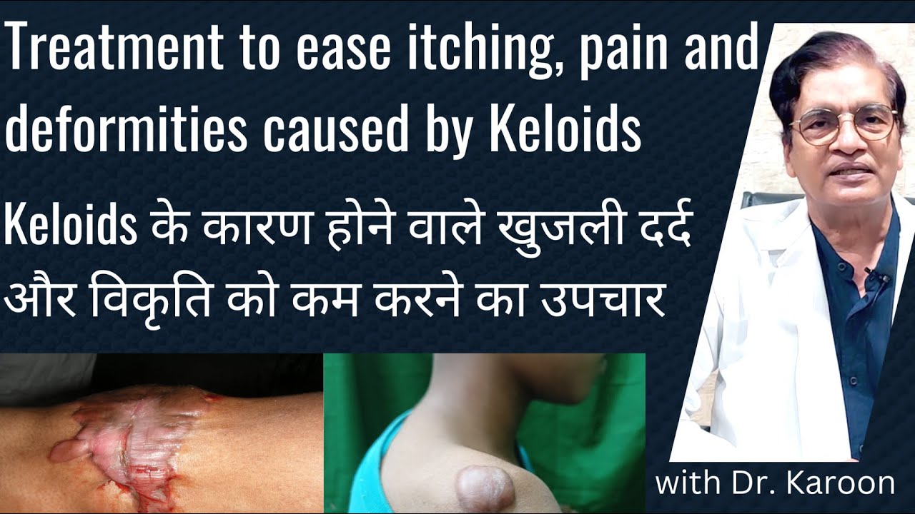 Treatment to ease itching pain and deformities caused by Keloids in ...