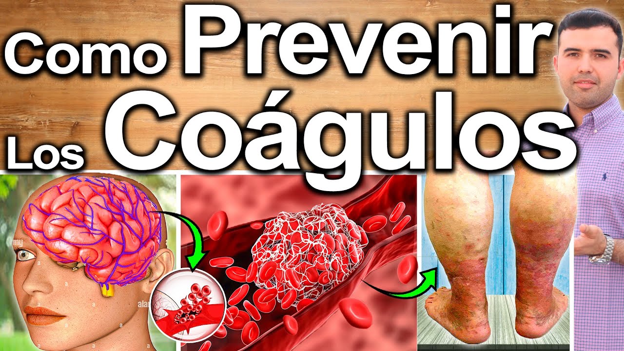 CÓMO PREVENIR COÁGULOS Y TROMBROS EN TU SANGRE - Revierte Los Coágulos ...