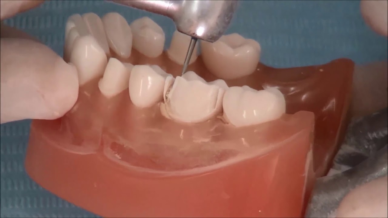 Metal ceramic crown preparation | For Dental Students - YouTube