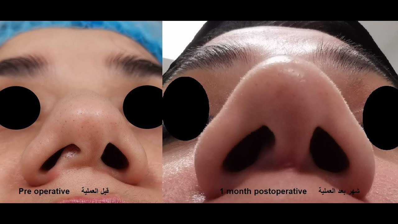 Columellar dislocation - Dr. Ahmed Nofal - YouTube