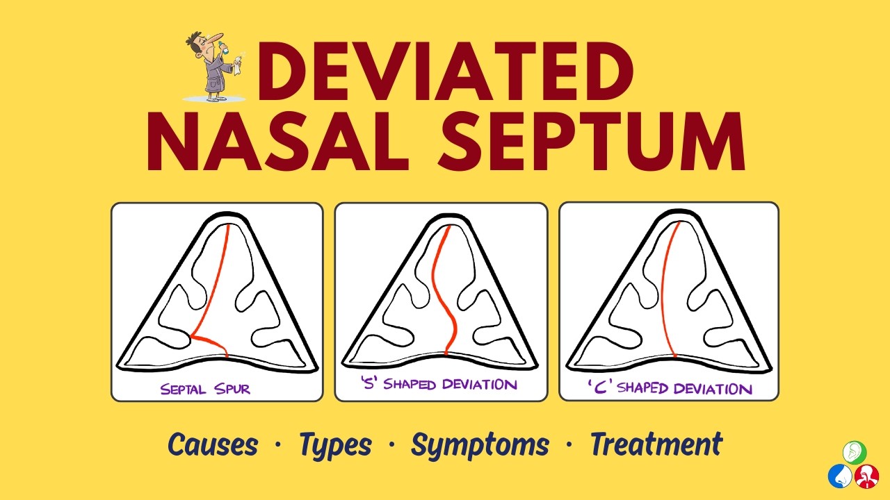 Deviated Nasal Septum (DNS) | Causes, Types, Symptoms, Treatment - YouTube
