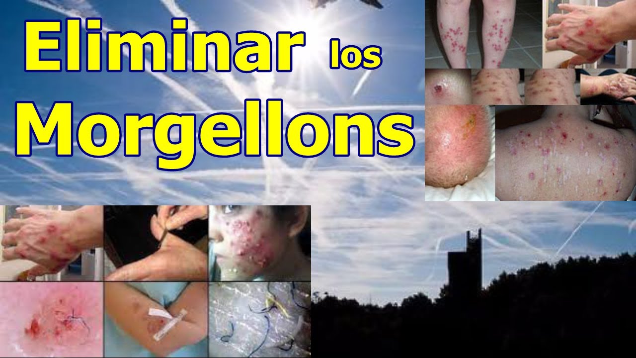 EXTRACCIÓN Y ELIMINACIÓN DE MORGELLONS DE FORMA NATURAL ¿QUÉ LOS CAUSA ...