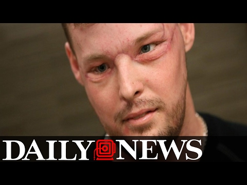 Face Transplant Patient Thrilled With Results Of The Operation