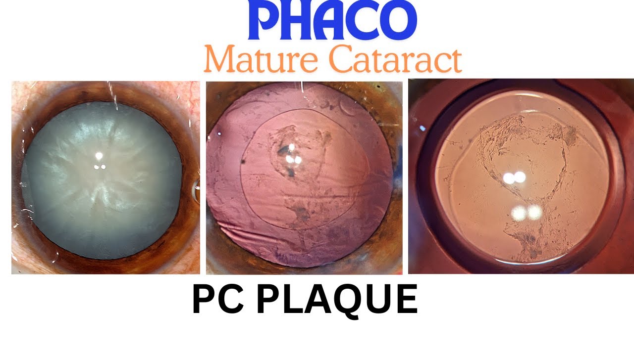 PC Plaque, Mature intumescent Cataract, Phacoemulsification, - YouTube